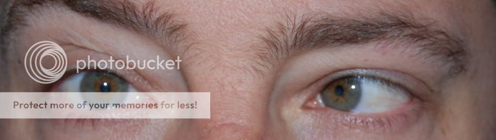 Do boss-eyed people see double vision? | Naked Science Forum